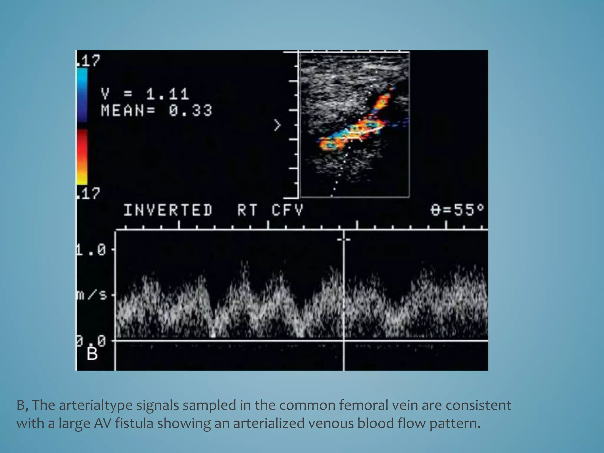 Peripheral arterial doppler | PPTX