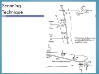 Peripheral arterial doppler | PPTX