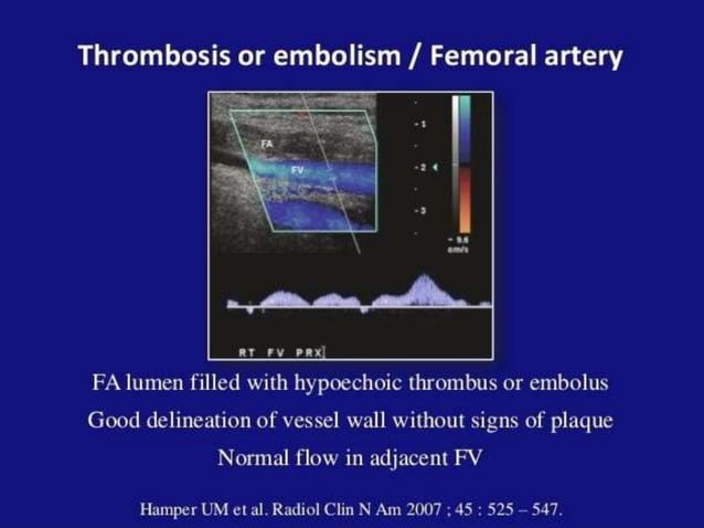 Peripheral Arteries Usg-1.pptx