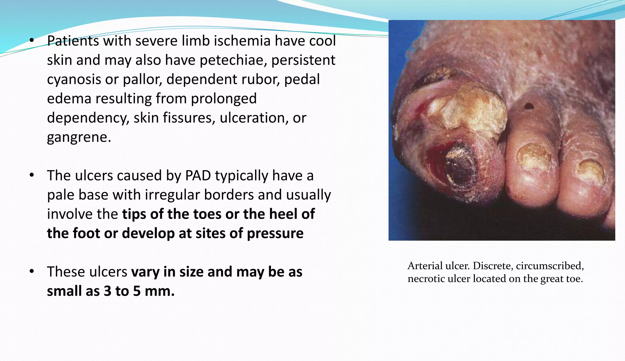Peripheral artery disease | PPTX