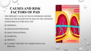 Peripheral Artery Disease.pptx