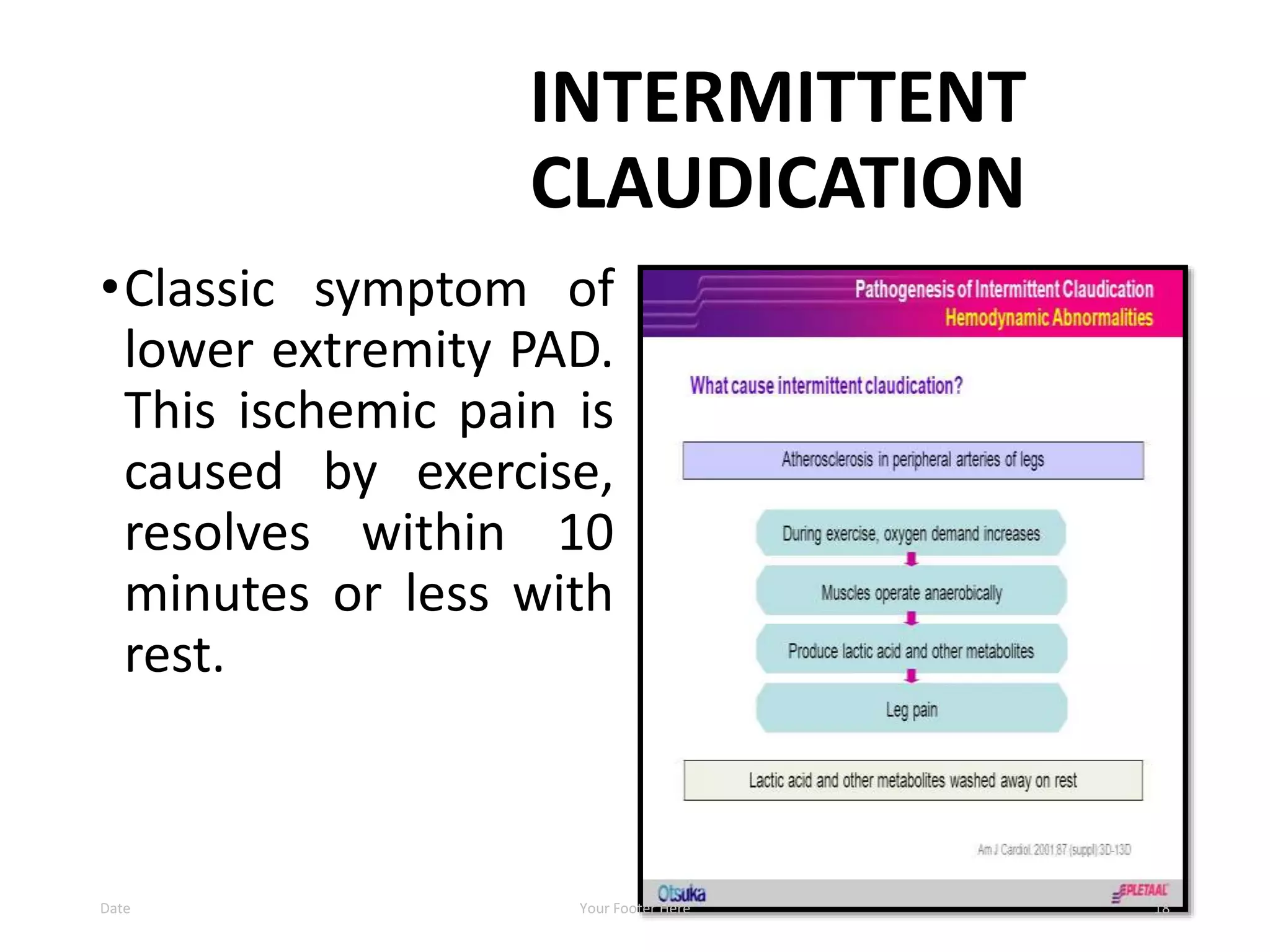 Peripheral artery disease nikku | PPTX