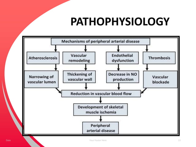 Peripheral artery disease nikku