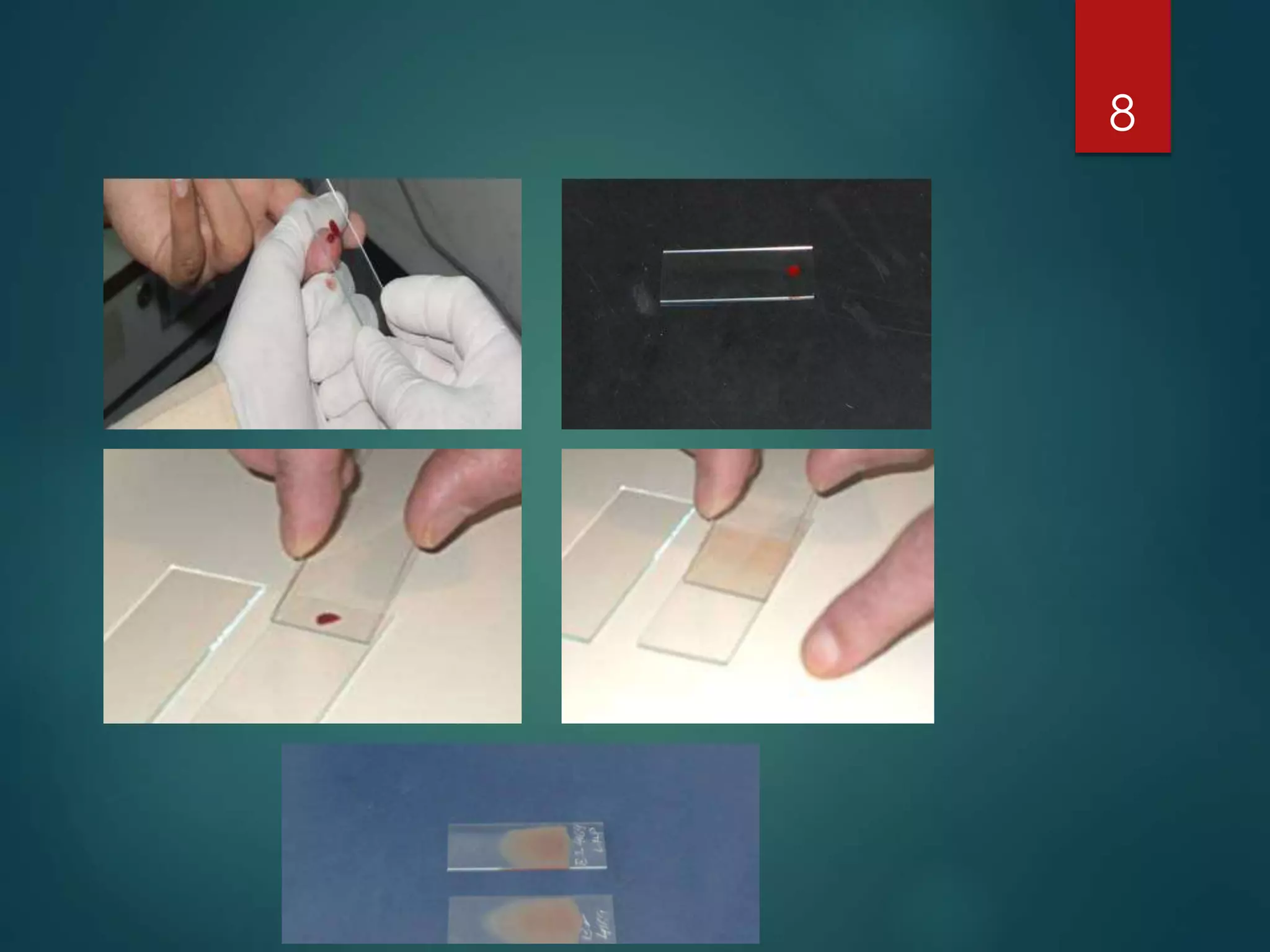 Peripheral Blood Smear | PPTX