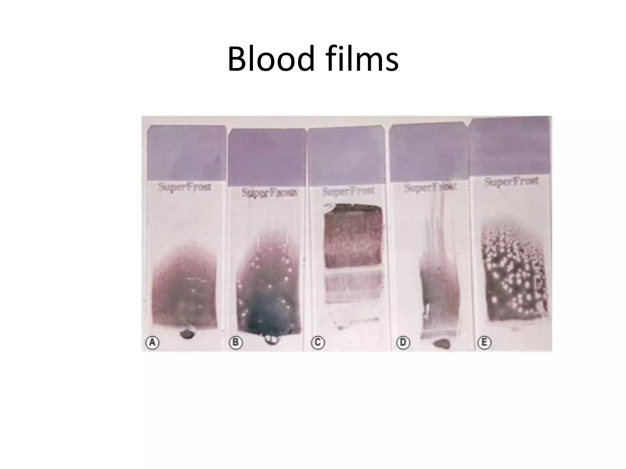 Peripheral blood smear examination | PPTX