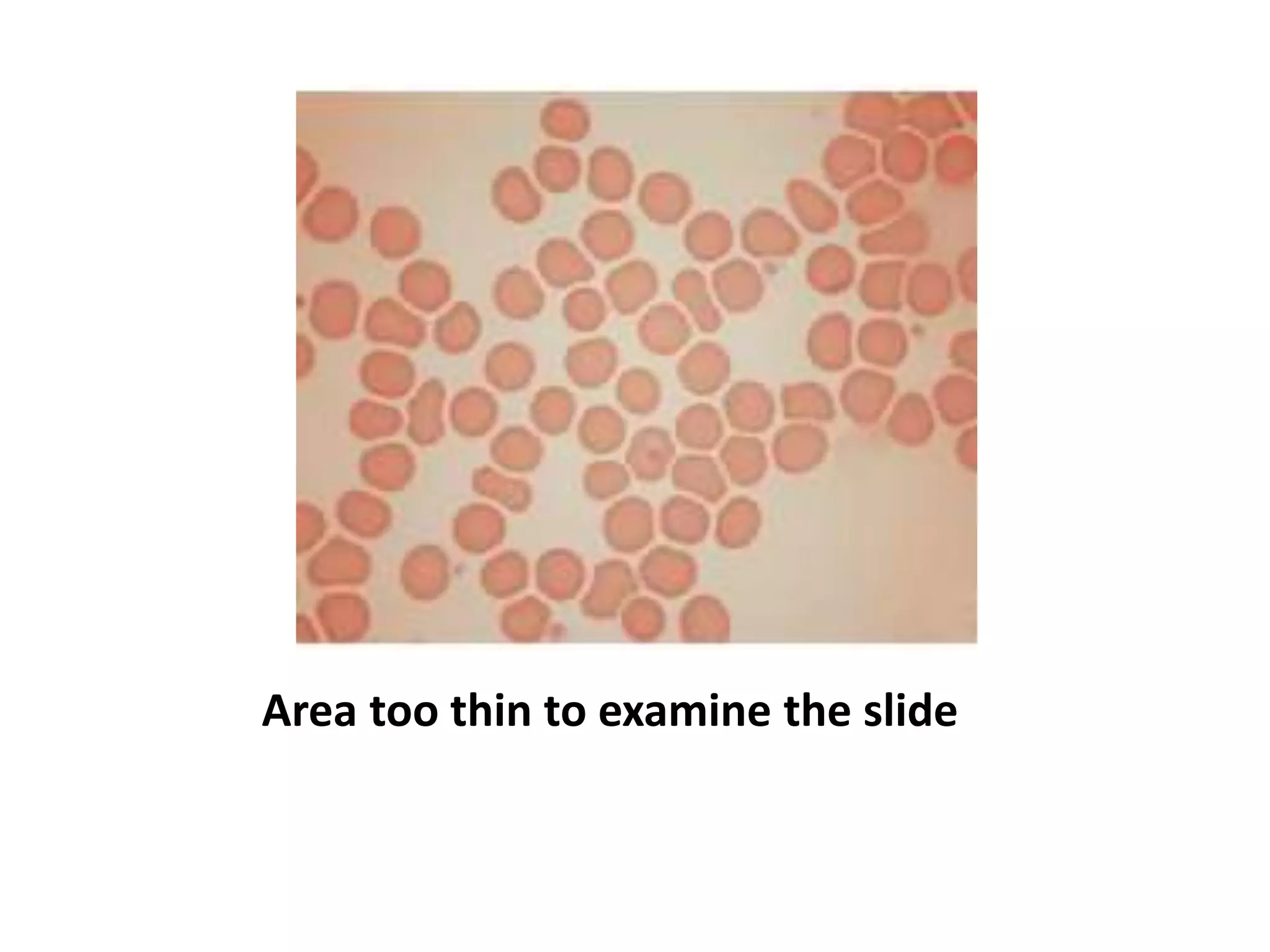 Peripheral blood smear examination | PPTX