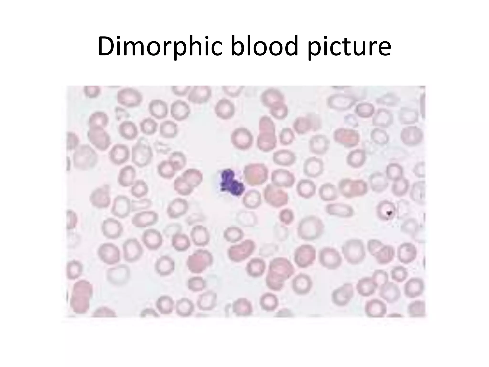 Peripheral blood smear examination | PPTX