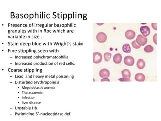 Basophilic Stippling Thalassemia