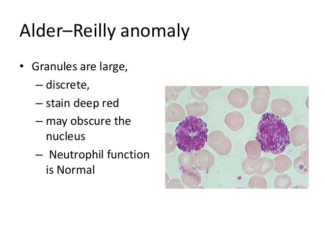 Alder Reilly Vs Toxic Granulation Nonmalignant Leukocyte Disorders