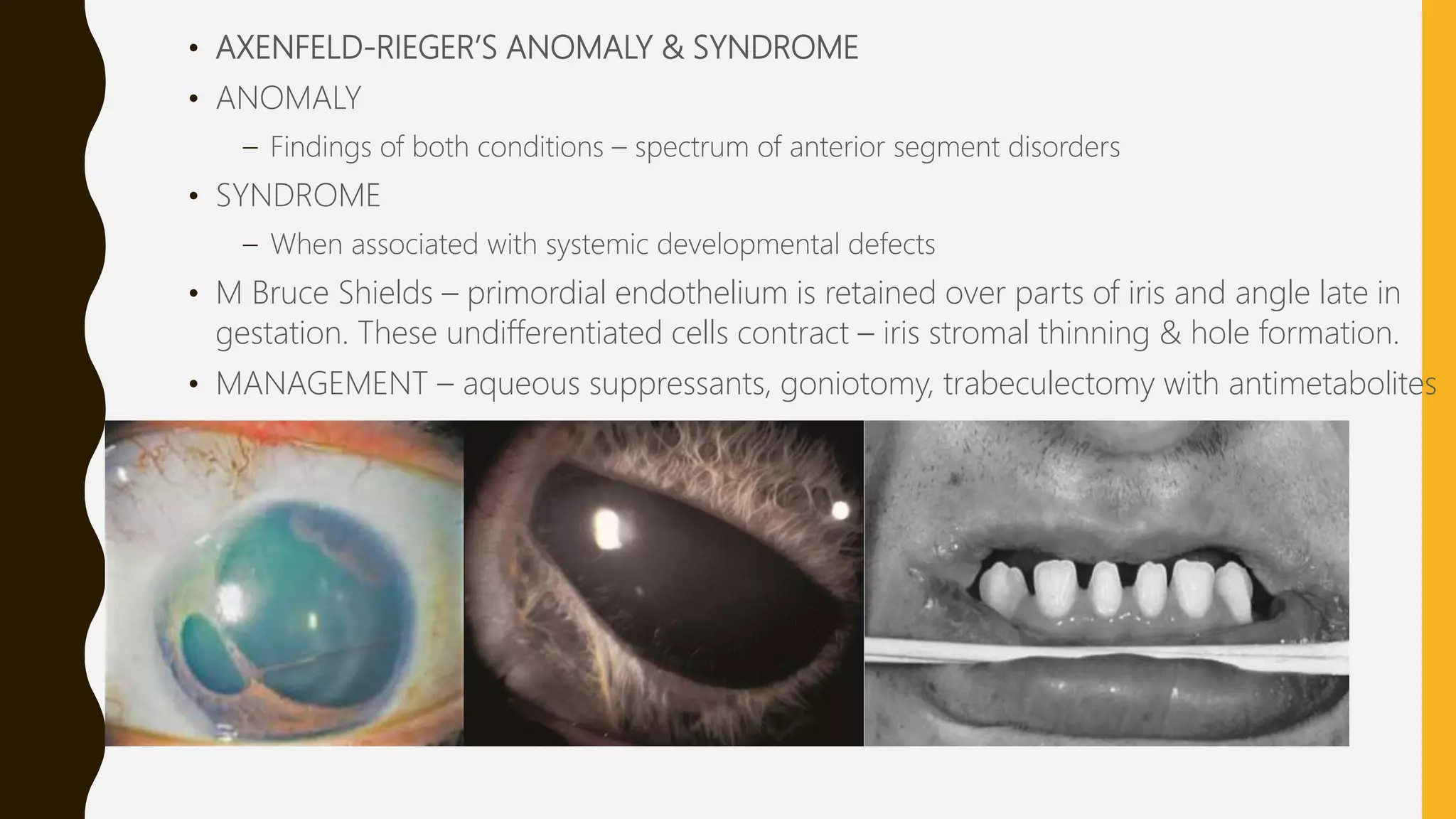 Peripheral corneal diseases | PPTX