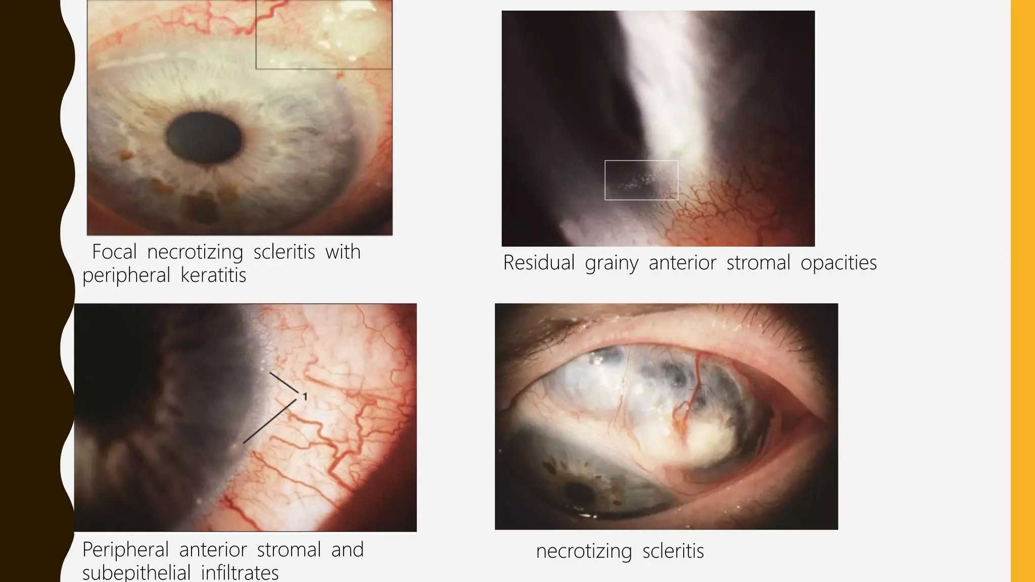 Peripheral corneal diseases | PPTX