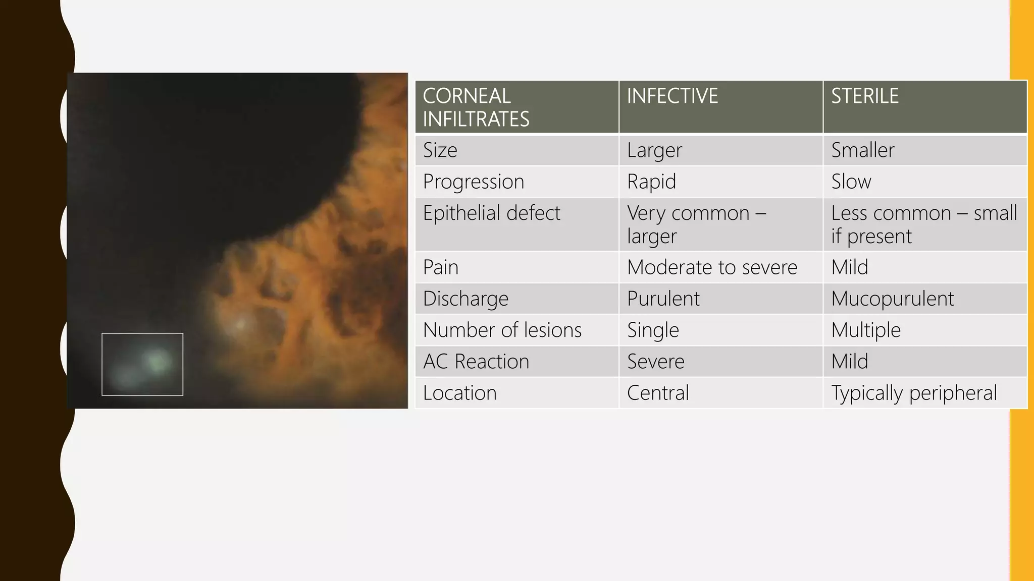 Peripheral corneal diseases | PPTX