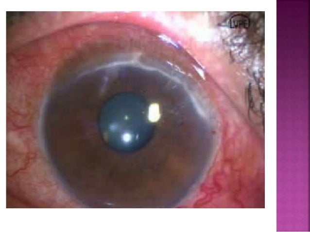 Peripheral corneal ulcers and corneal degenerations