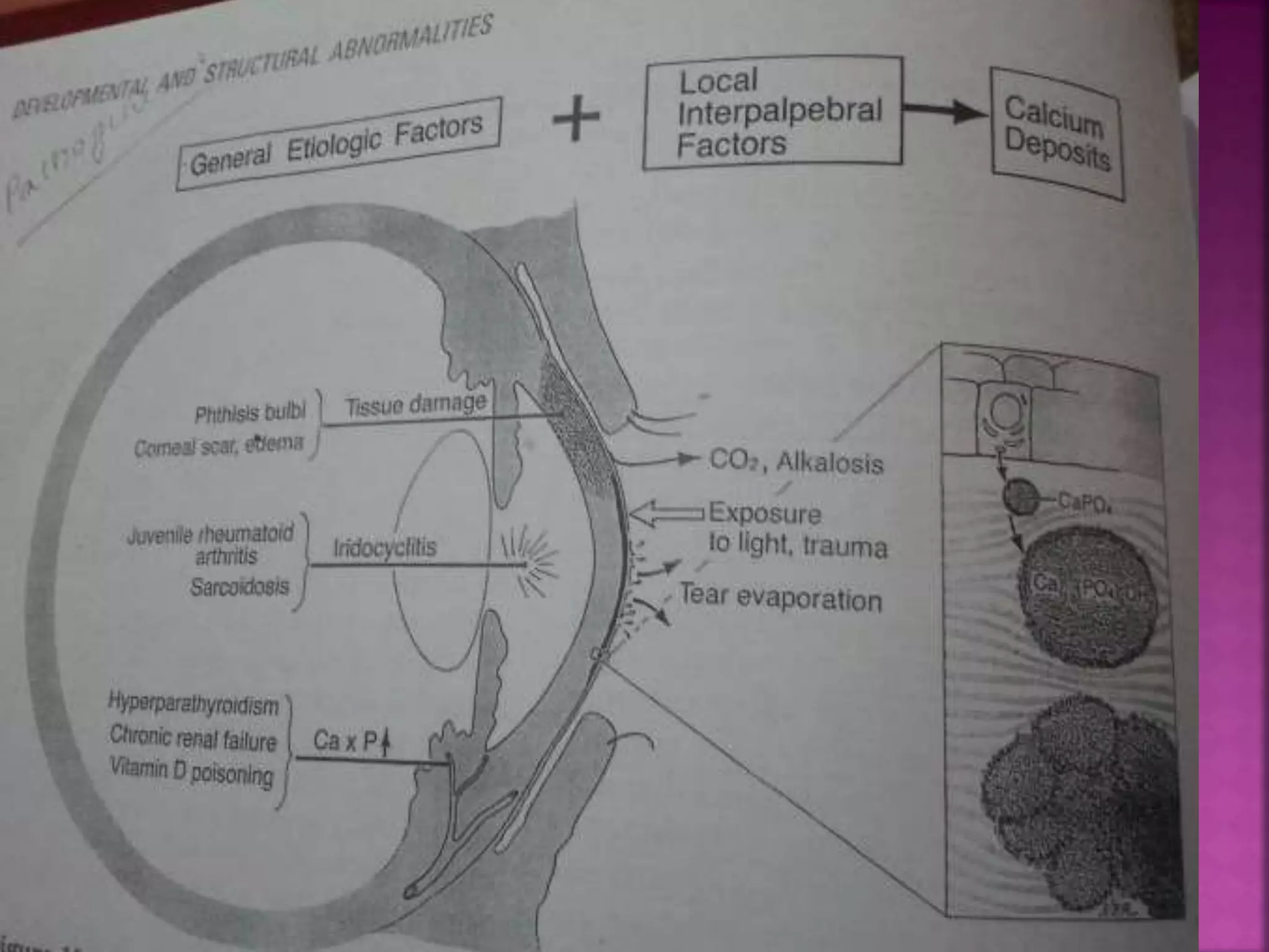 Peripheral corneal ulcers and corneal degenerations | PPT