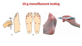 management of peripheral diabetic neuropathy .pptx