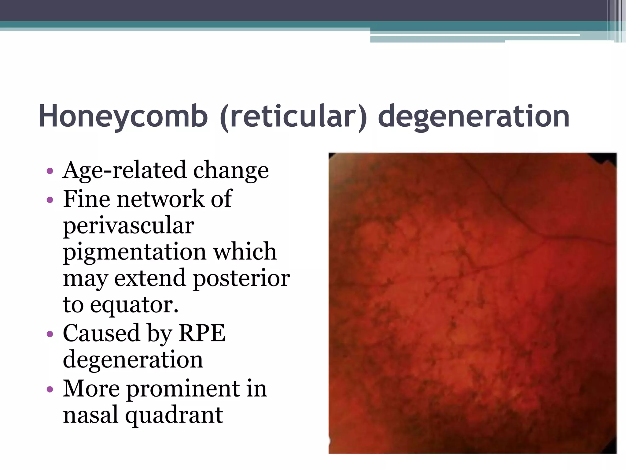 Peripheral fundus & its disorders | PPTX