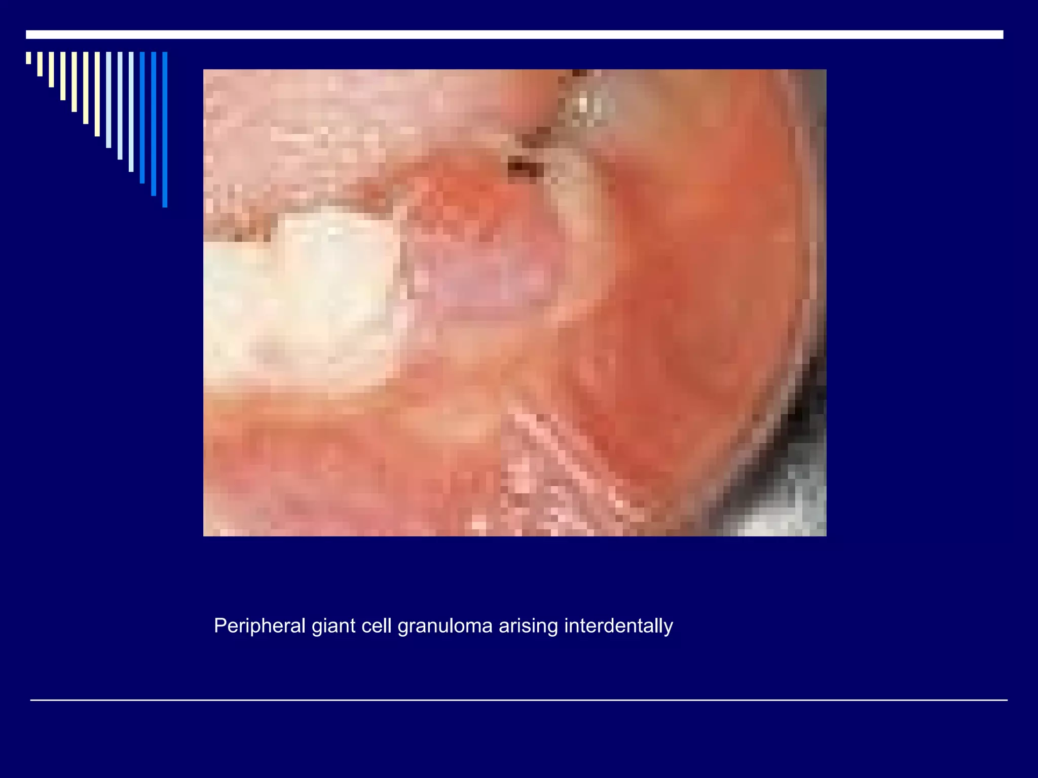 Peripheral giant cell granuloma (giant cell epulis | PPT