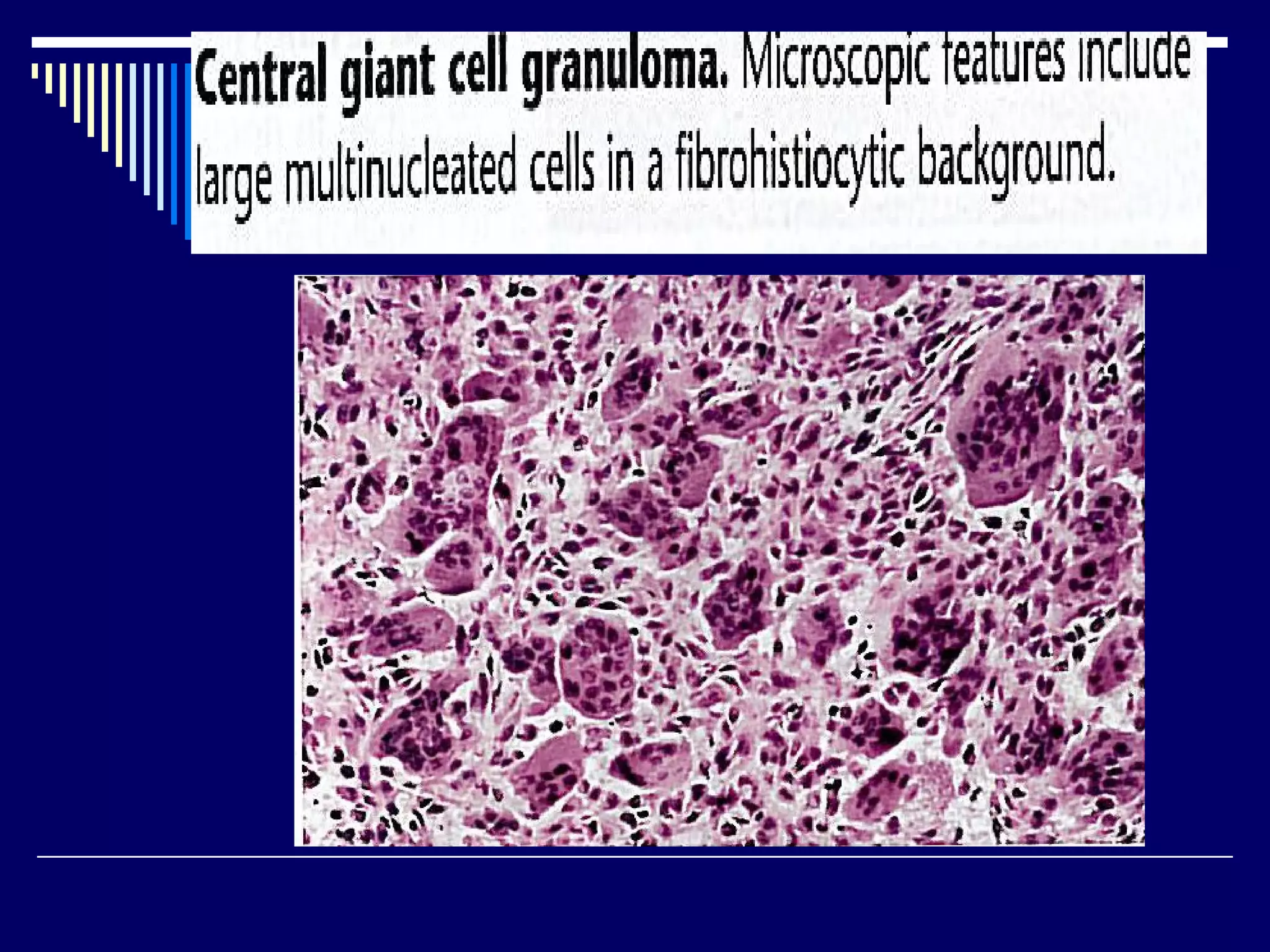 Peripheral giant cell granuloma (giant cell epulis | PPT