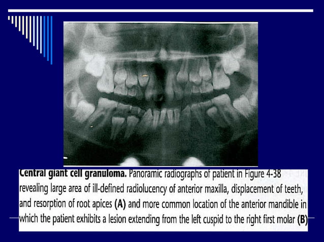 Peripheral giant cell granuloma (giant cell epulis | PPT | Dental ...