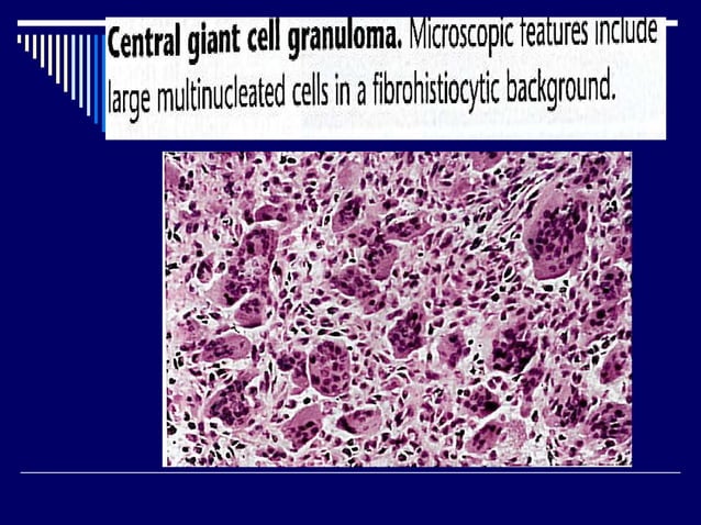 Peripheral giant cell granuloma (giant cell epulis | PPT | Dental ...