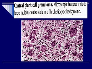 Peripheral Giant Cell Granuloma Histology