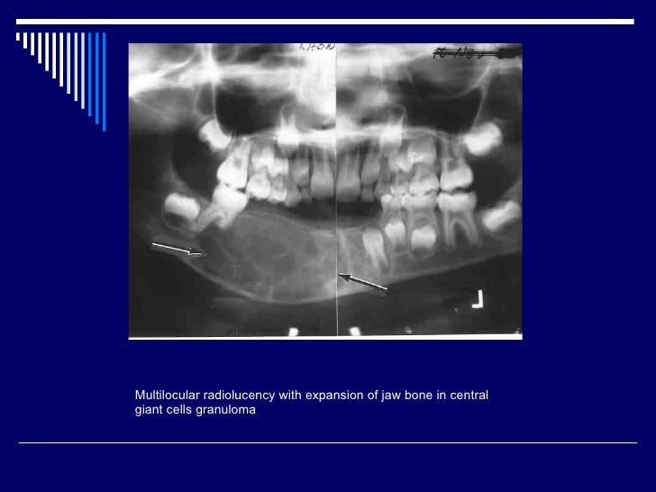 Peripheral Giant Cell Granuloma Radiograph