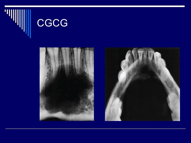 Peripheral giant cell granuloma (giant cell epulis