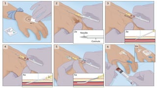 Peripheral intravenous catheter insertion Dr. Zeinab Gamal.pptx