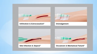 Peripheral intravenous catheter insertion Dr. Zeinab Gamal.pptx