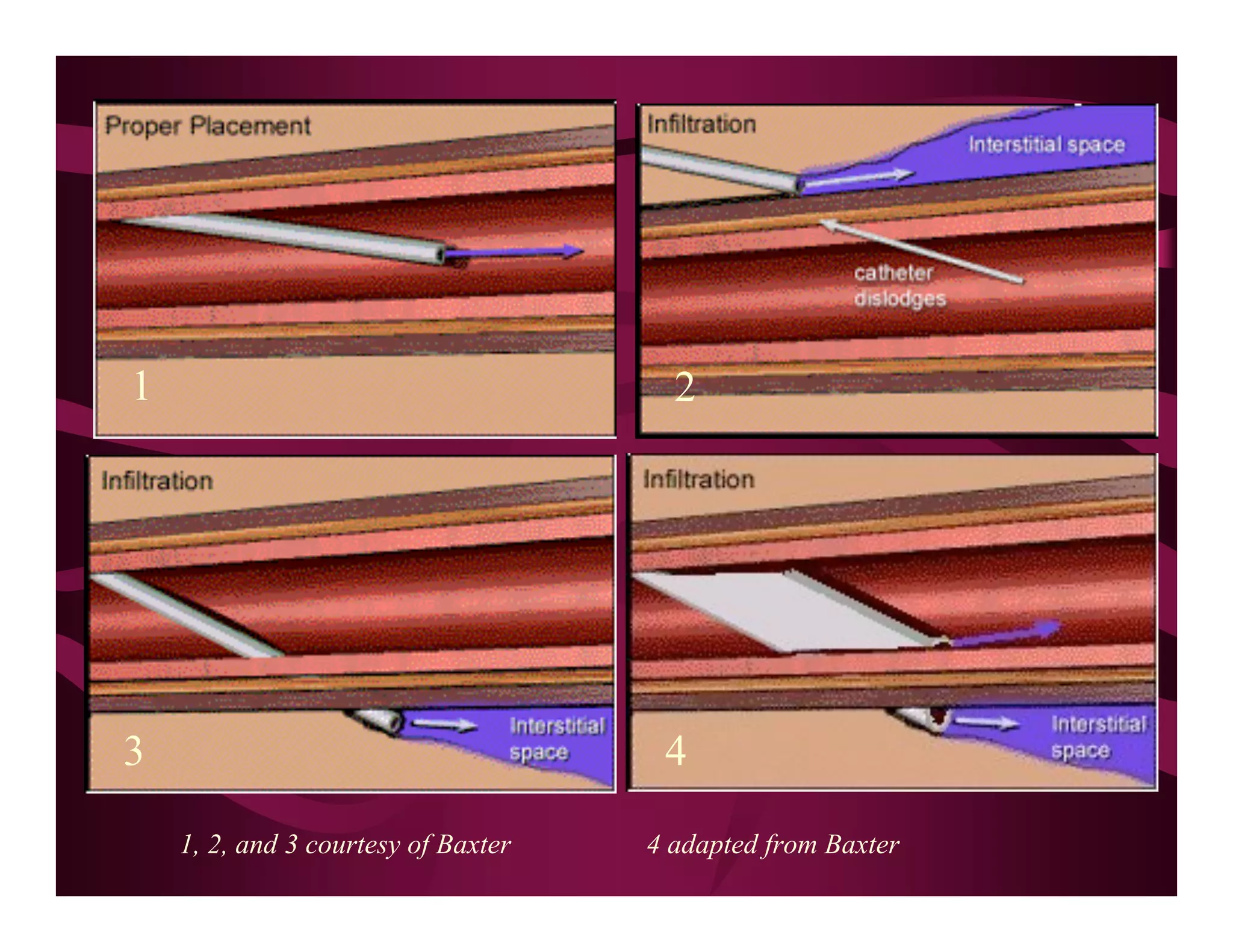 Peripheral IV Therapy | PPT