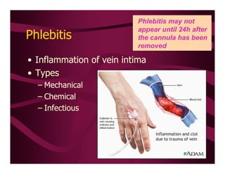 Phlebitis Iv