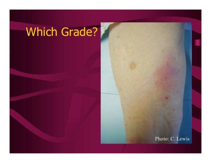 Peripheral IV Therapy