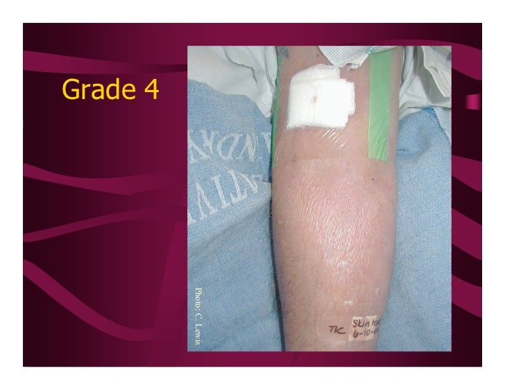 Peripheral IV Therapy