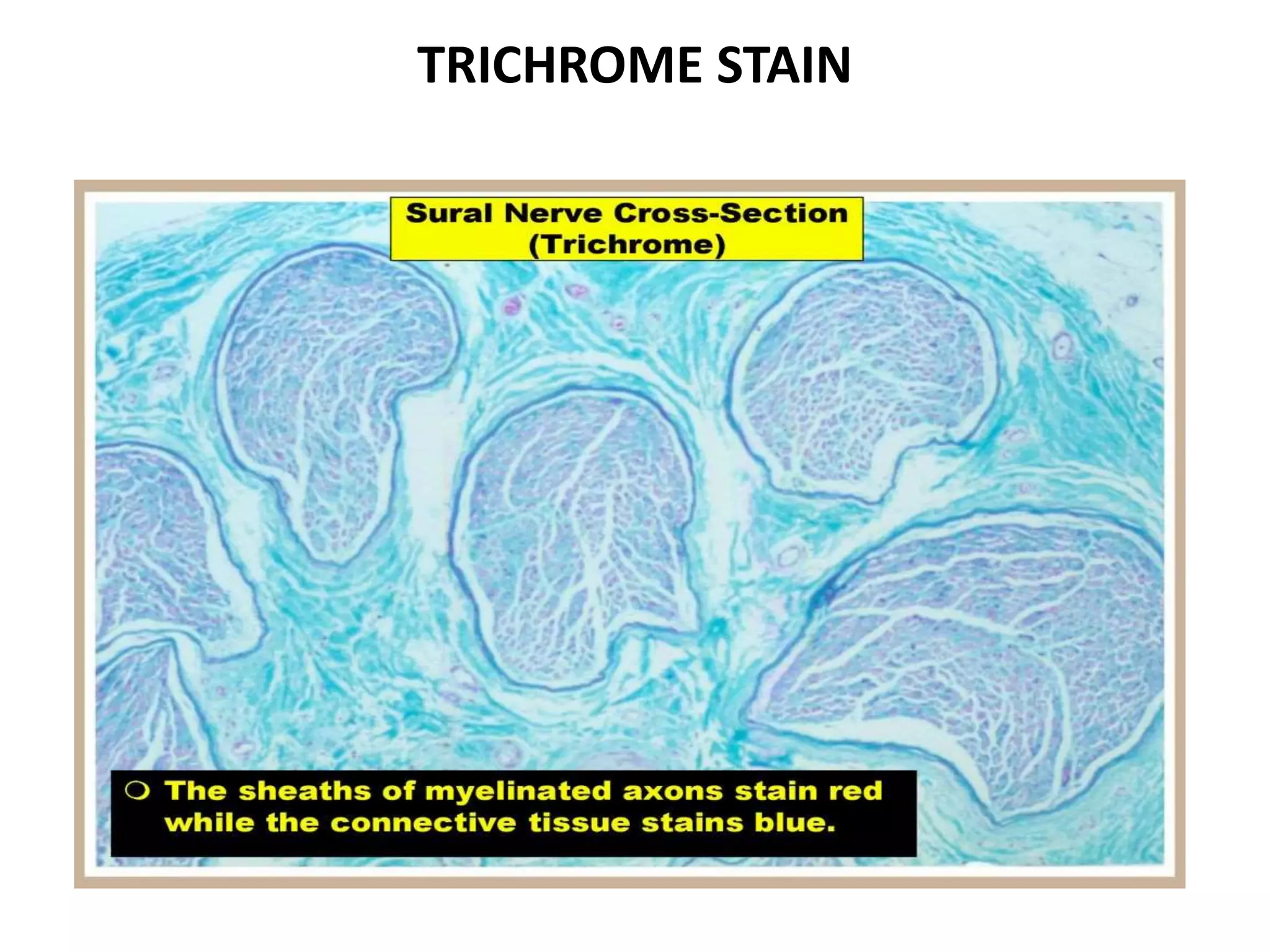 Peripheral nerve biopsy | PPTX