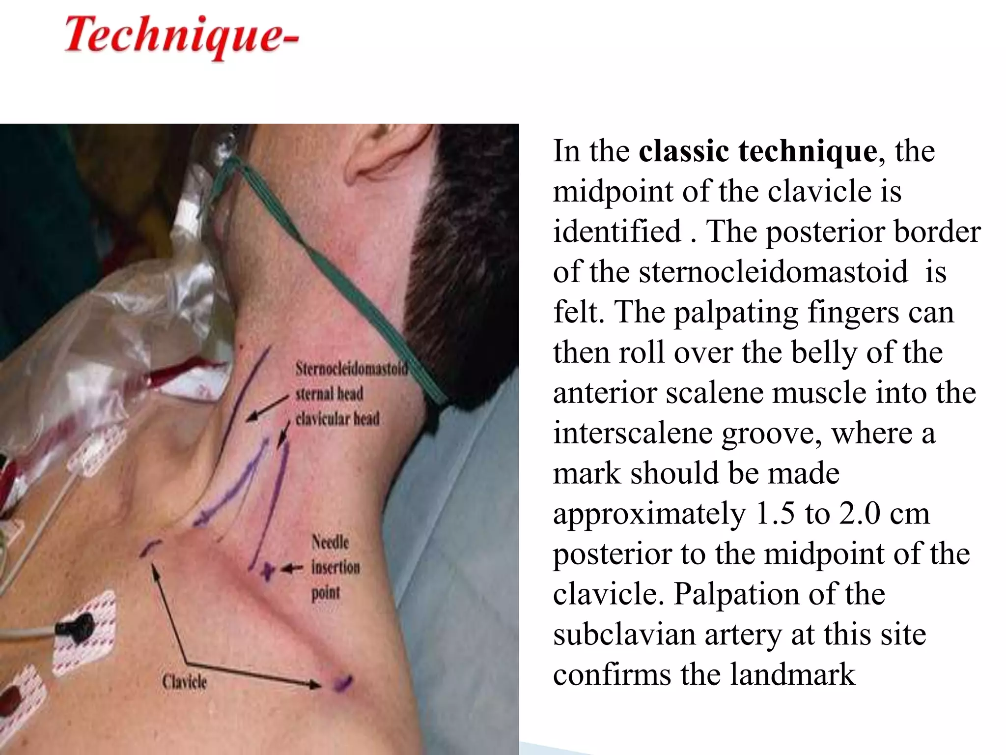 Peripheral nerve blocks | PPTX