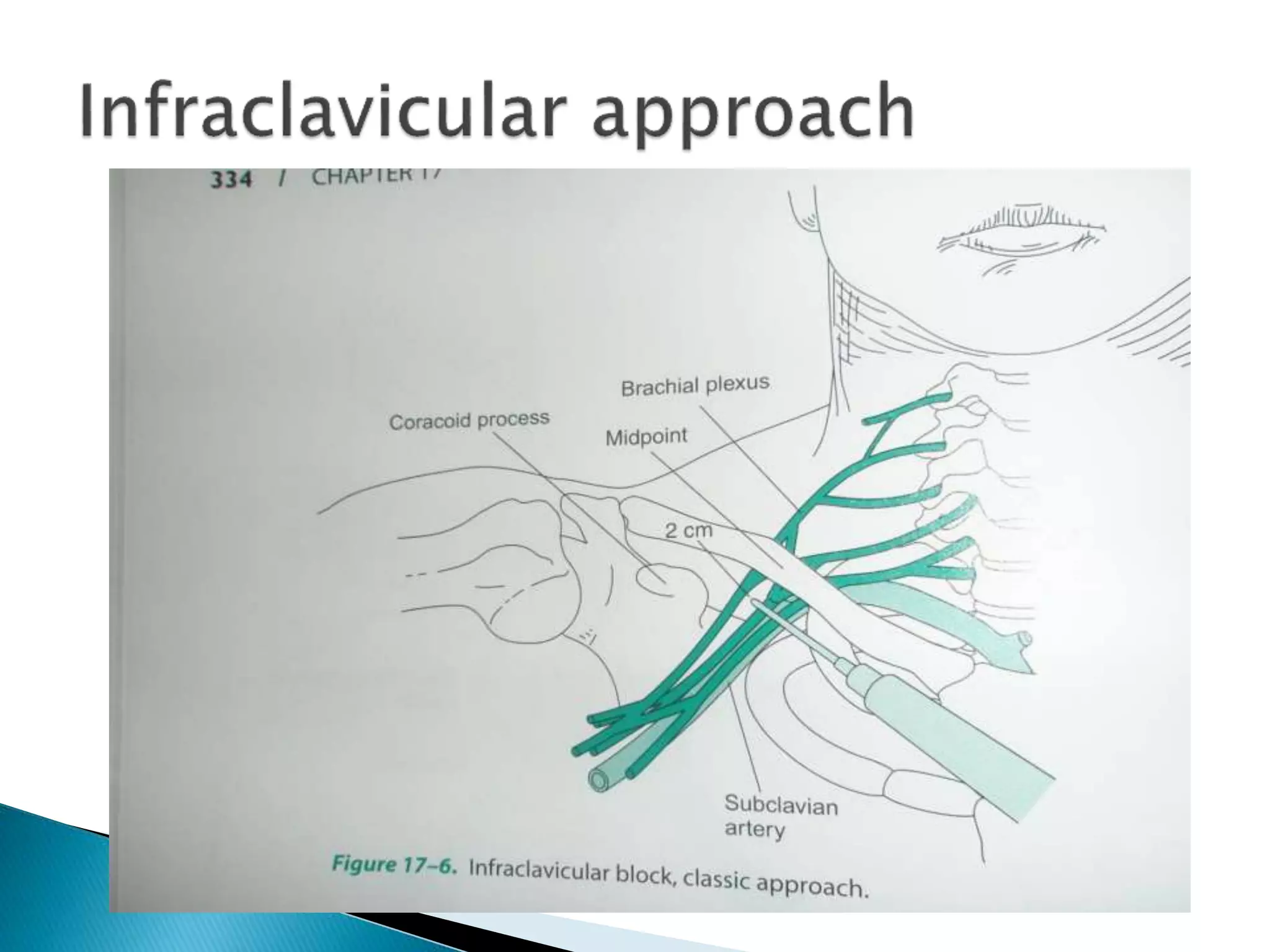 Peripheral nerve blocks | PPTX