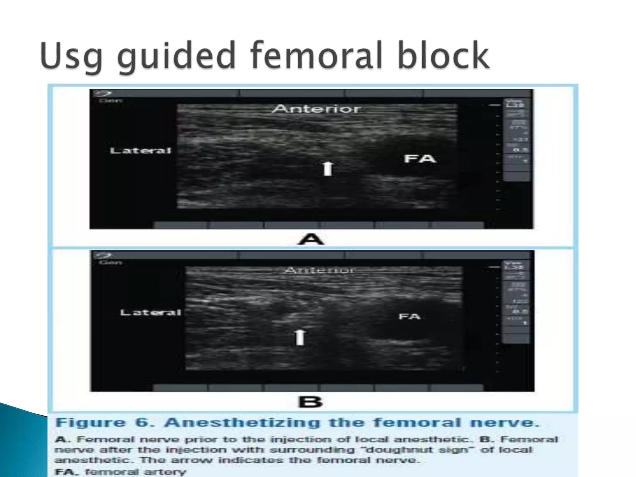 Peripheral nerve blocks | PPTX