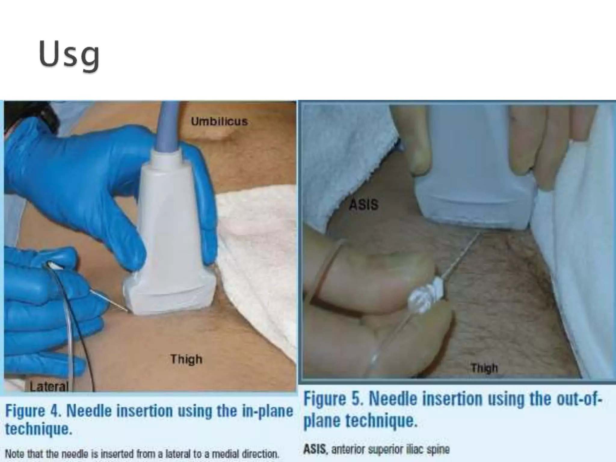 Peripheral nerve blocks | PPTX