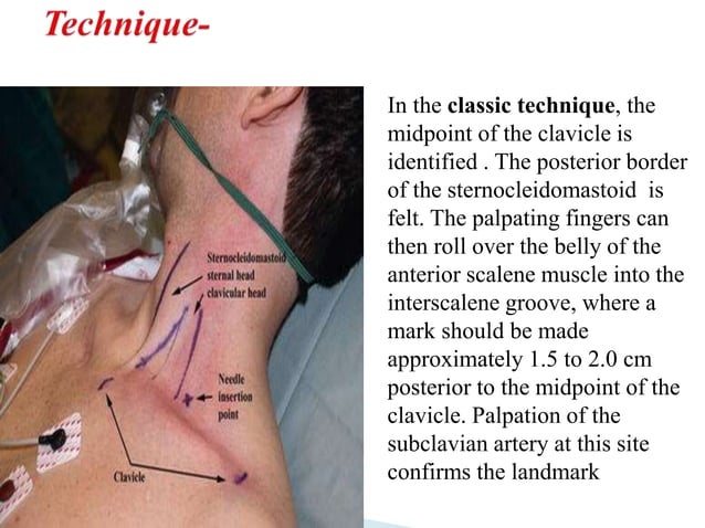 Peripheral nerve blocks | PPTX | First Aid | Injuries