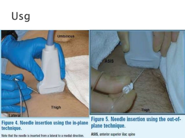 Peripheral nerve blocks | PPTX | First Aid | Injuries