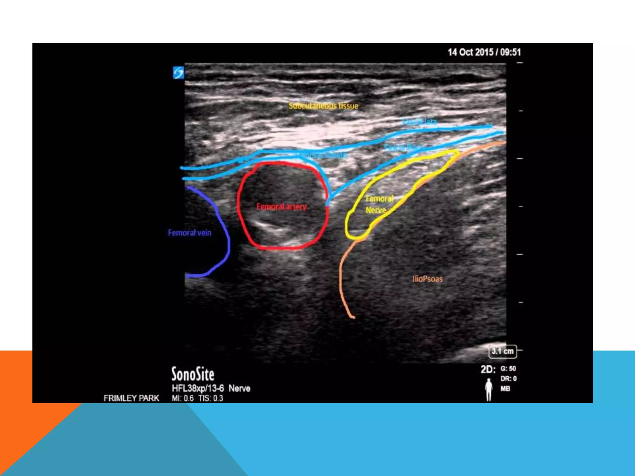 US Guided Lower Limb Nerve Blocks | PPTX