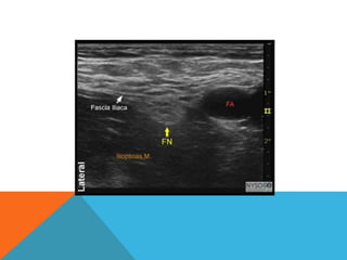 US Guided Lower Limb Nerve Blocks | PPT