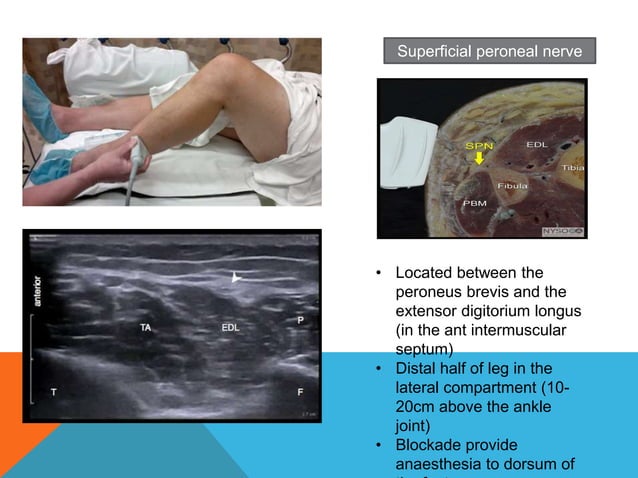 US Guided Lower Limb Nerve Blocks