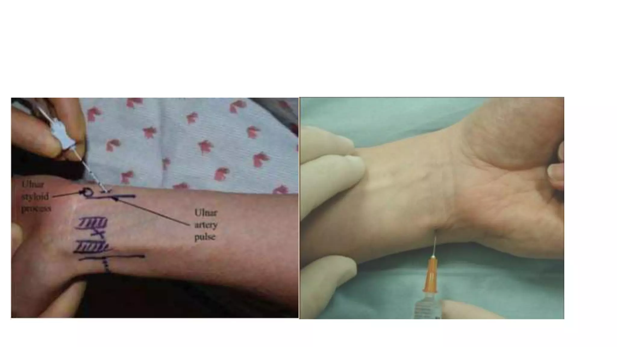 Peripheral Nerve Blocks of the Arm.pptx