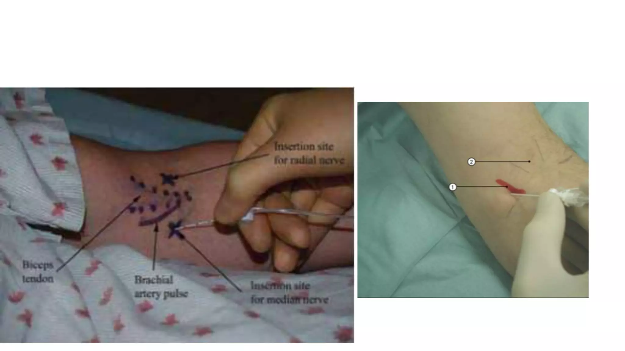 Peripheral Nerve Blocks of the Arm.pptx
