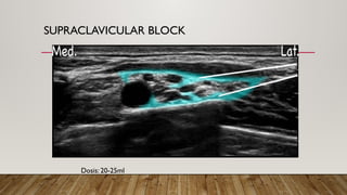 Peripheral Nerve Block Supraclavicular dan TAP.pptx