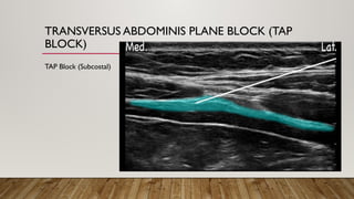 Peripheral Nerve Block Supraclavicular dan TAP.pptx