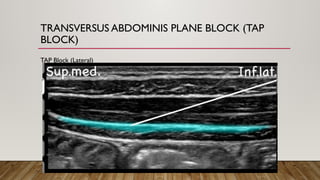 Peripheral Nerve Block Supraclavicular dan TAP.pptx