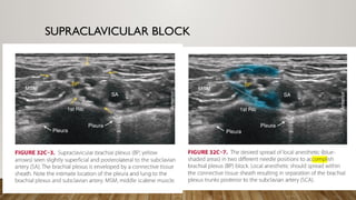 Peripheral Nerve Block Supraclavicular dan TAP.pptx