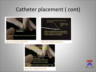 Peripheral Nerve Catheters | PPT